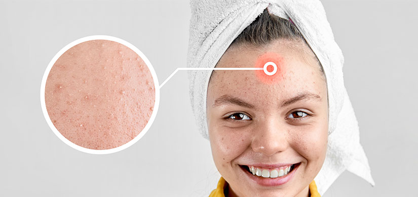 Acneea este o boală. Și se tratează! - Dermatolog Elena Crihan Iași