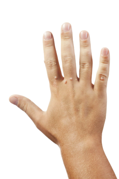 Negii sau verucile - Doctor dermatolog Elena Crihan - Iași